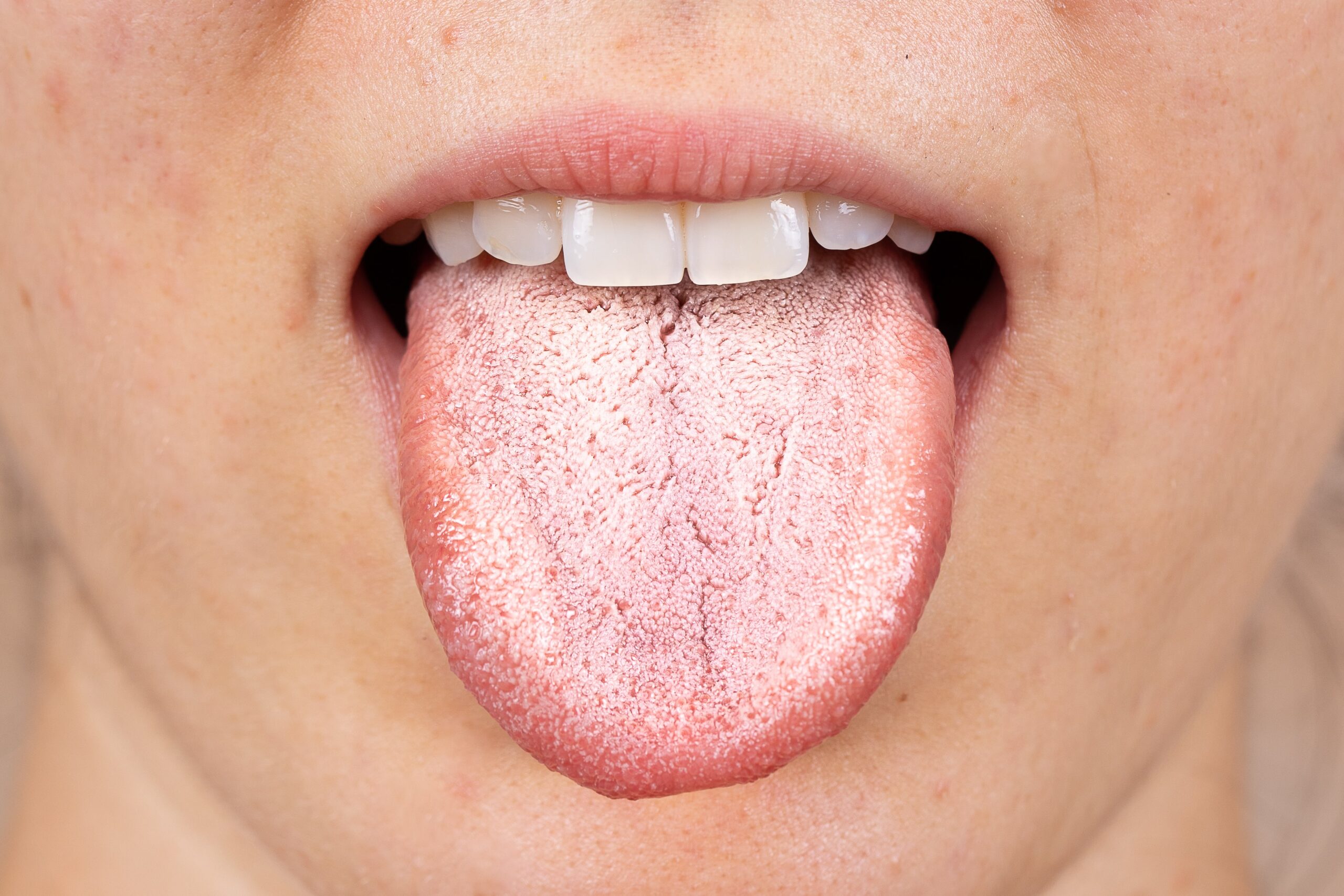 Lengua saburral: por qué tienes la lengua blanca y cómo eliminarla ...